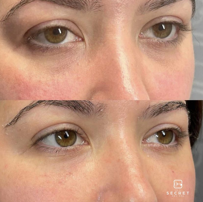 Undereye Injection Treatments | It's A Secret Med Spa