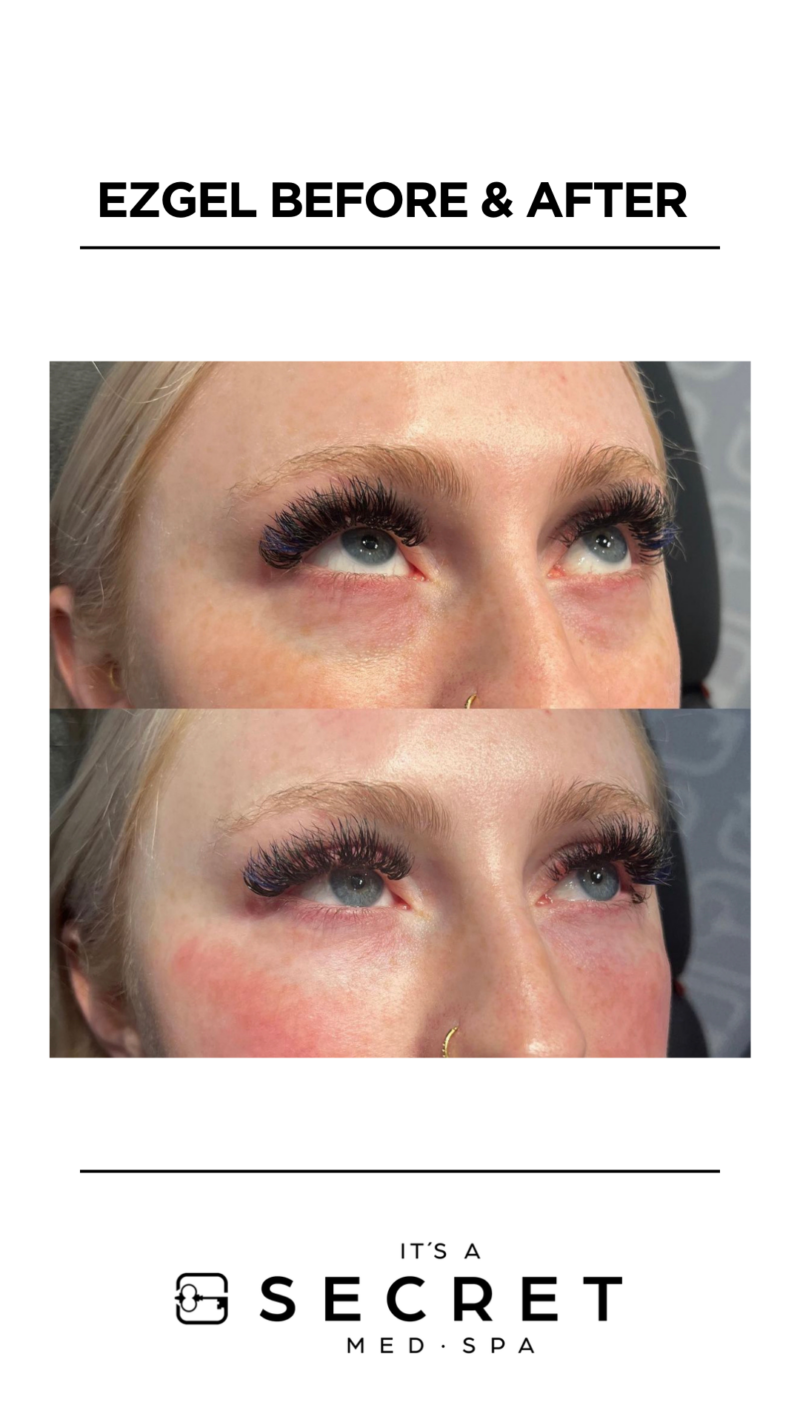 #1 for EZGel Natural Fillers | It's a Secret Med Spa