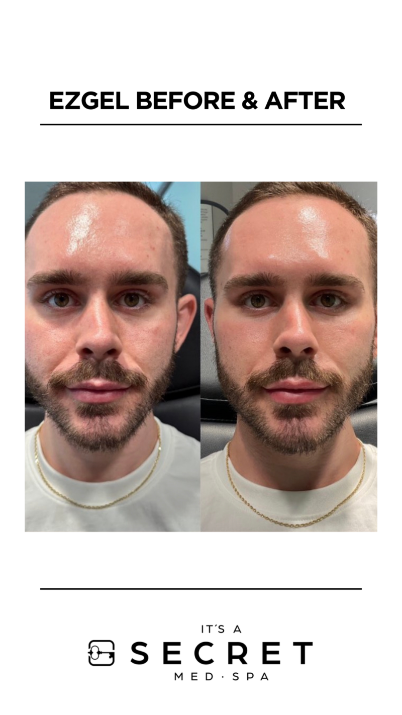 #1 for EZGel Natural Fillers | It's a Secret Med Spa